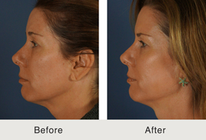 Botox Charlotte, NC | Carolina Facial Plastics