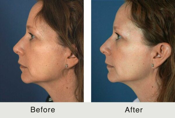 Cheek Fillers 101: Everything You Need to Know - Carolina Facial Plastics