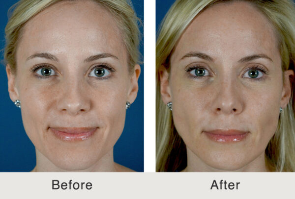 Temple Augmentation - Carolina Facial Plastics