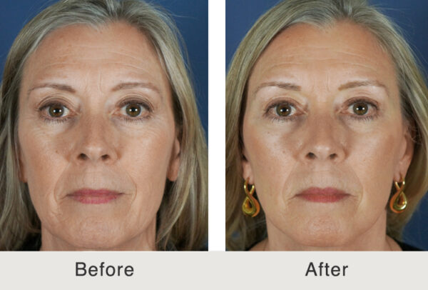 Facelift Cost in Charlotte: What Patients Should Know Before Planning ...