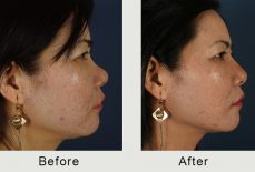 Does Your Nose Grow with Age? | North Carolina Facial Plastic Surgeon
