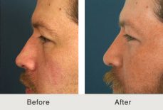 What’s the Difference Between Open and Closed Rhinoplasty? - Carolina ...