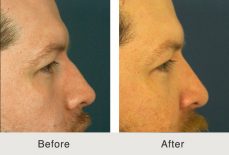 Does Your Nose Grow with Age? | North Carolina Facial Plastic Surgeon
