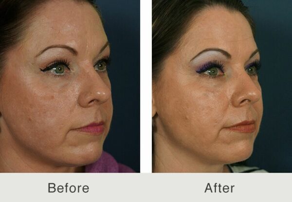 Cheek Fillers 101: Everything You Need to Know - Carolina Facial Plastics