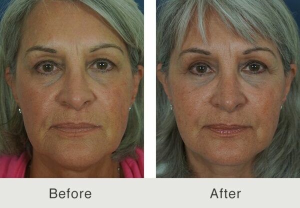 Custom Facial Implants - Carolina Facial Plastics