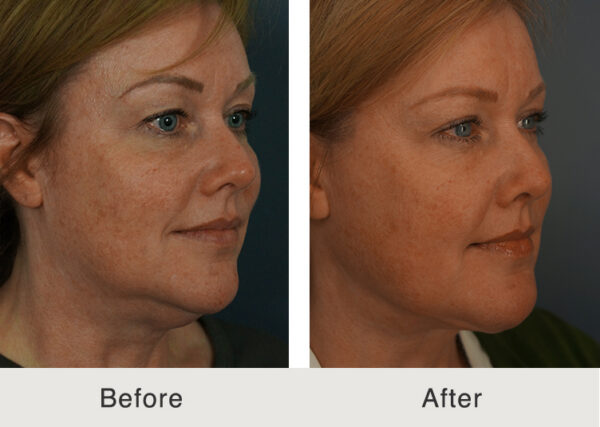 Get a Stronger Jawline with a Mandibular Implant - Carolina Facial Plastics