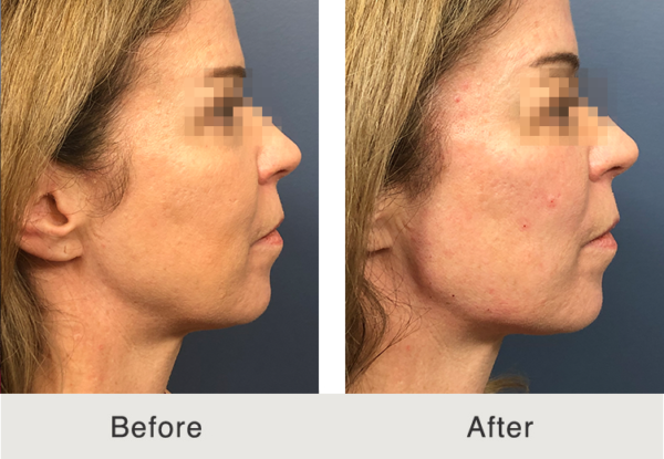 5 Ways To Lift Your Cheeks - Carolina Facial Plastics