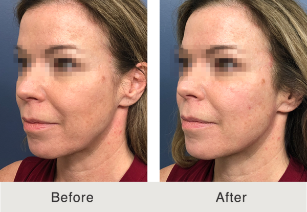 Looking to Get High, Prominent Cheekbones? These Procedures Could Be ...