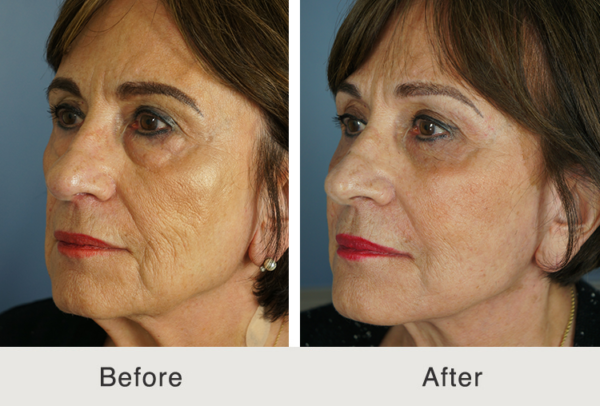 Deep Plane Facelift in Charlotte - Carolina Facial Plastics