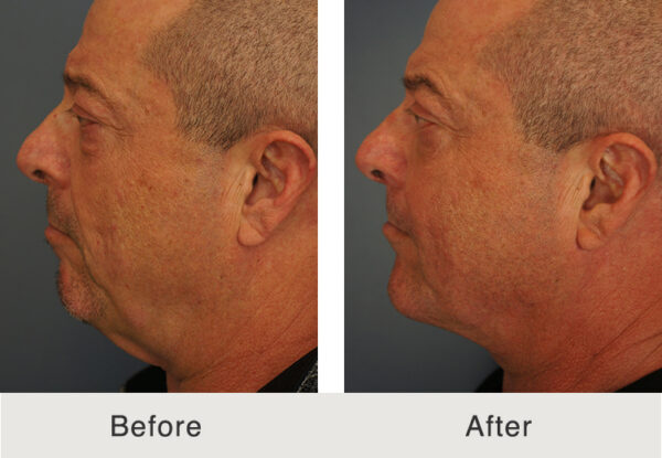 5 Tips for a Quick Neck Lift Recovery - Carolina Facial Plastics