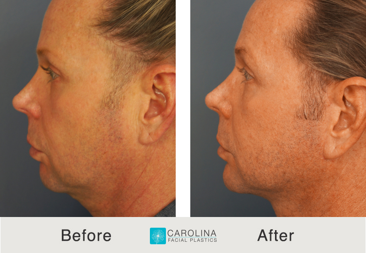 Facial Fat Grafting Before & After Photos | Carolina Facial Plastics
