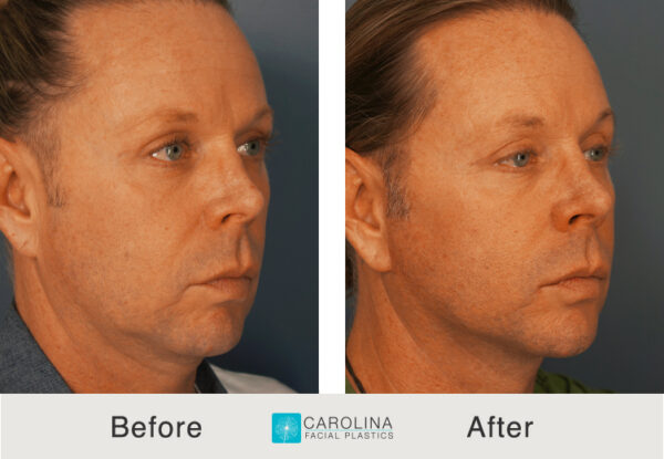 5 Ways To Lift Your Cheeks - Carolina Facial Plastics