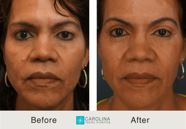 How to Reduce Chubby Cheeks and Create a Slimmer Face - Carolina Facial ...