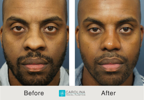 Alarplasty / Wide Nostril Reduction Surgery in Charlotte - Carolina ...