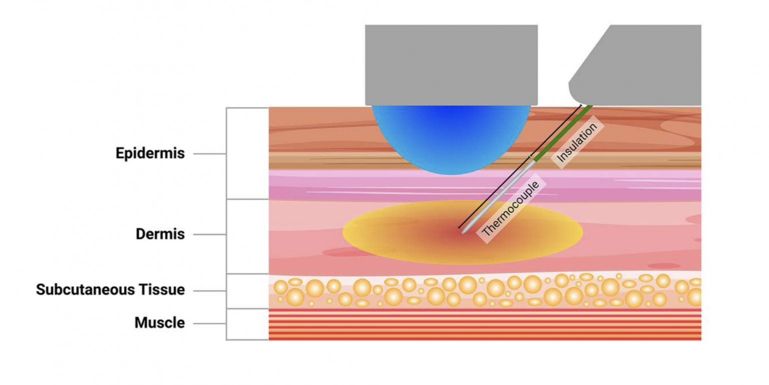 ProfoundRF Non-Surgical Skin Tightening | Charlotte, NC