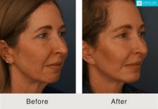 Mini Facelift in Charlotte, NC | Carolina Facial Plastics