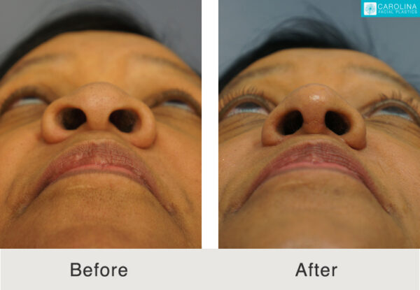 Upturned Nose Rhinoplasty Photos Charlotte, NC | Carolina Facial Plastics