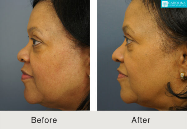 Upturned Nose Rhinoplasty Photos Charlotte, NC | Carolina Facial Plastics