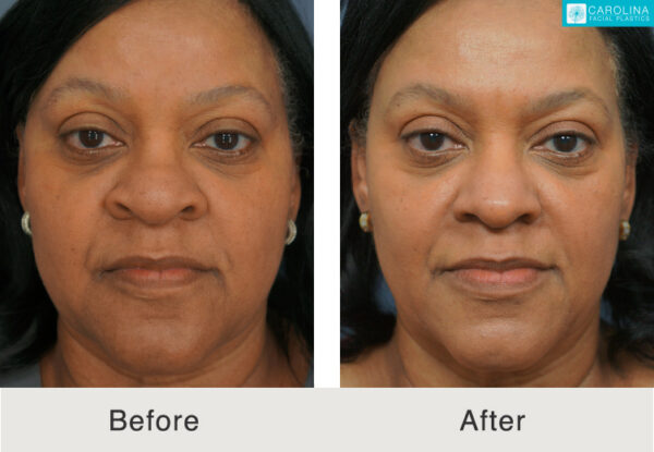 Upturned Nose Rhinoplasty Photos Charlotte, NC | Carolina Facial Plastics