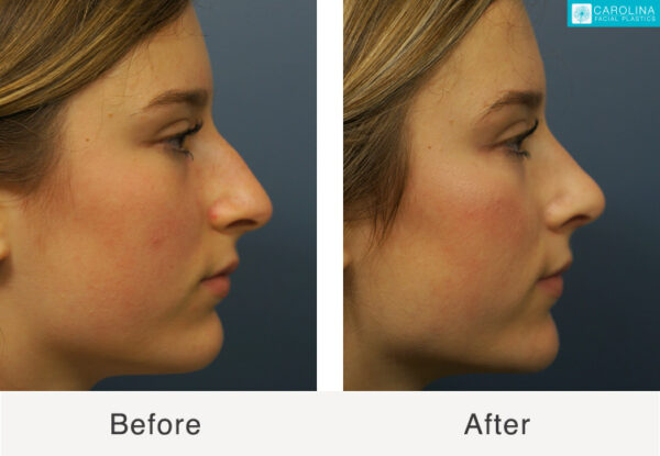 What’s the Difference Between Open and Closed Rhinoplasty? - Carolina ...