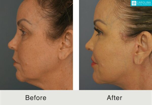 Lip Lift, Facelift, and Upper Eyelid Lift - Carolina Facial Plastics