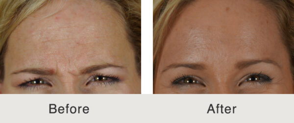 Botox for Migraines 101 - Carolina Facial Plastics