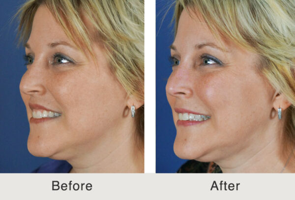 Botox: More than a Wrinkle Treatment - Carolina Facial Plastics