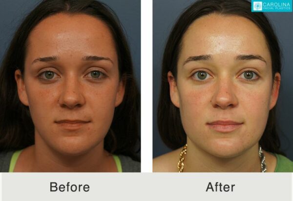 Custom Facial Implants - Carolina Facial Plastics