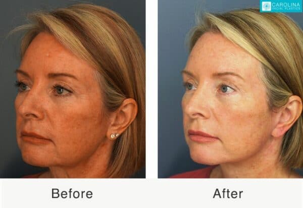 Mini Facelift in Charlotte, NC | Carolina Facial Plastics