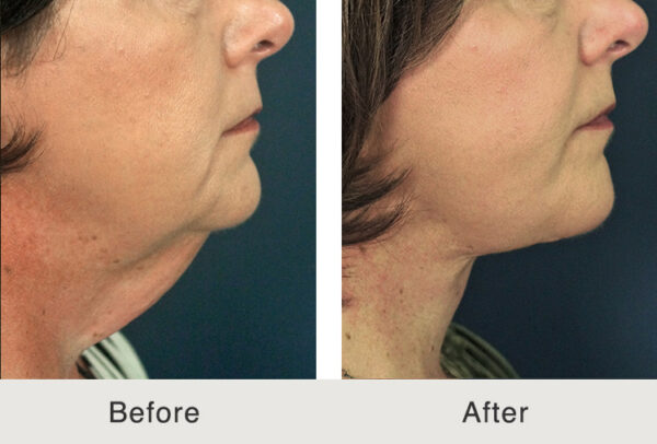 5 Solutions for an Aging Jawline - Carolina Facial Plastics
