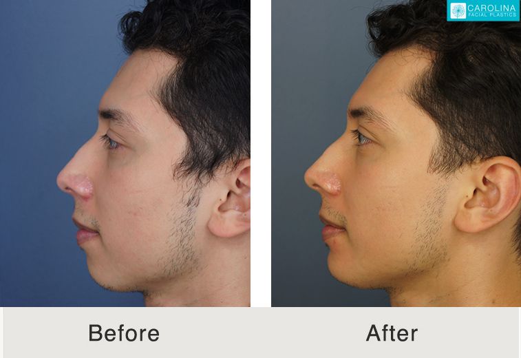 5 Solutions For An Aging Jawline Carolina Facial Plastics 5 Solutions For An Aging Jawline Carolina Facial Plastics