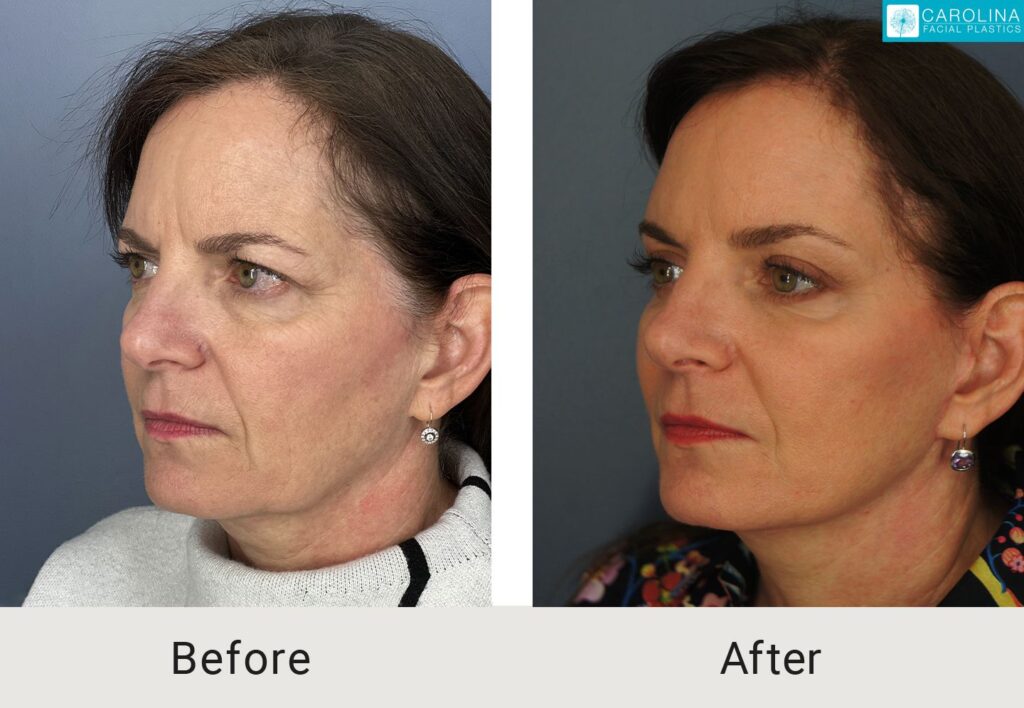 Ponytail Facelift in Charlotte - Carolina Facial Plastics