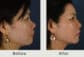 Does Your Nose Grow with Age? - Carolina Facial Plastics