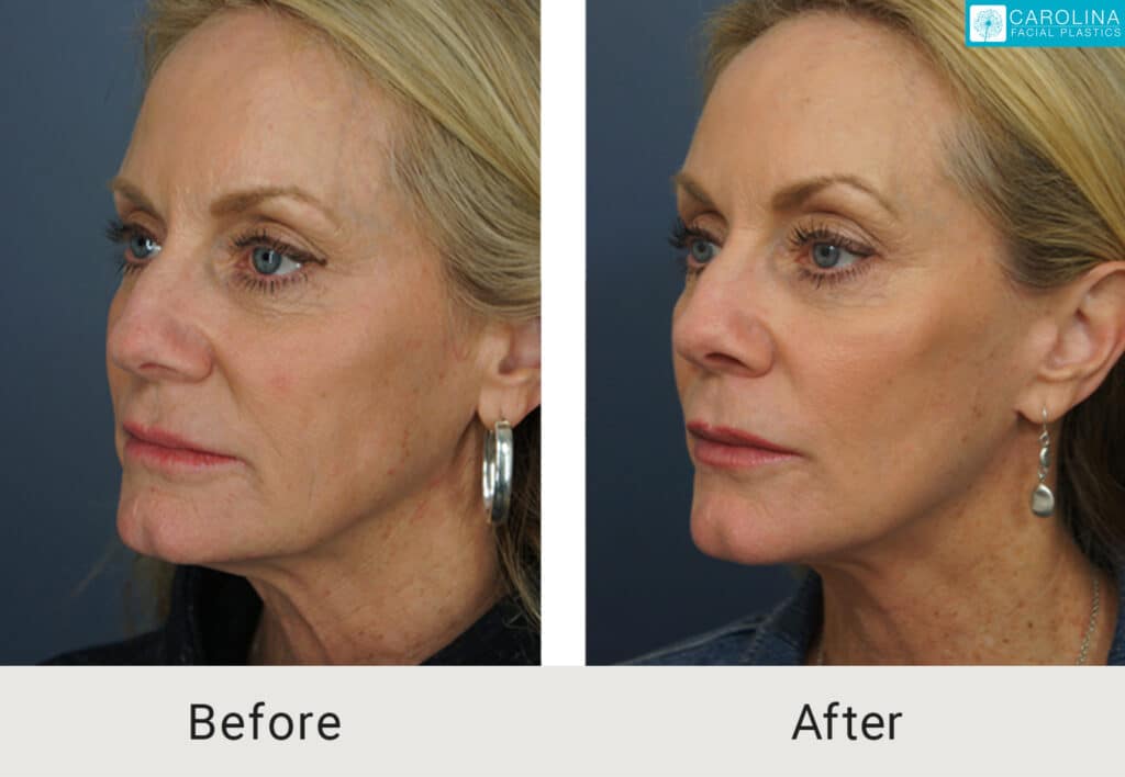 Mini Facelift in Charlotte, NC | Carolina Facial Plastics