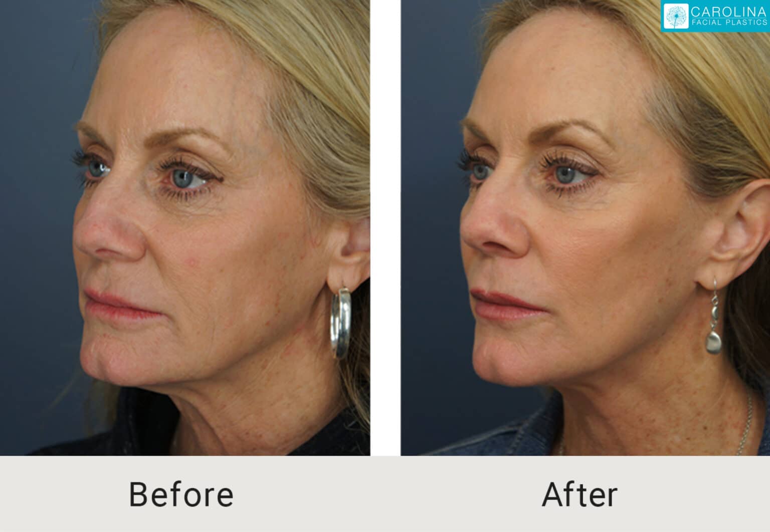 Mini Facelift in Charlotte, NC | Carolina Facial Plastics