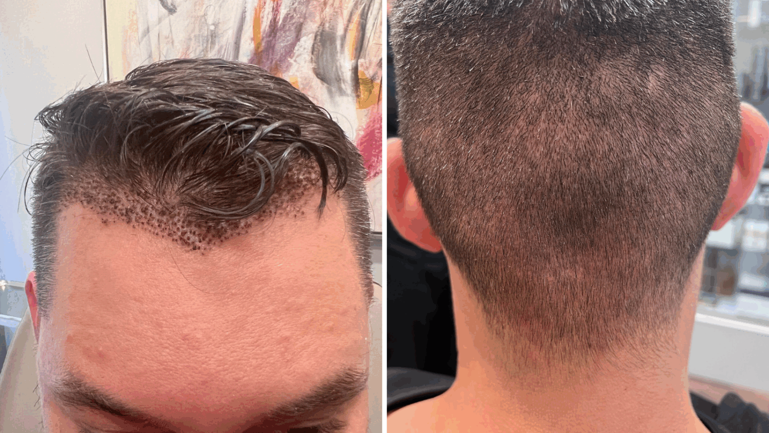 Neograft Hair Transplant in Charlotte - Carolina Facial Plastics