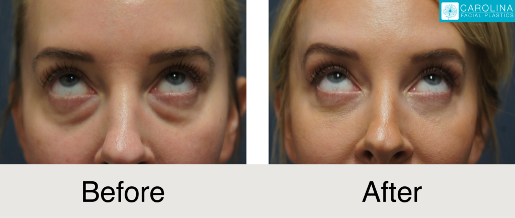 Lower Blepharoplasty - Carolina Facial Plastics
