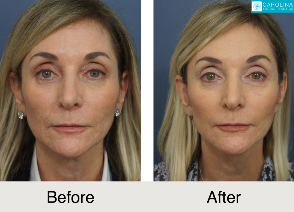 Mini Facelift to Refresh the Face - Carolina Facial Plastics