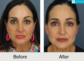 How to Get Rid of Chubby Cheeks and Improve Facial Contours - Carolina ...