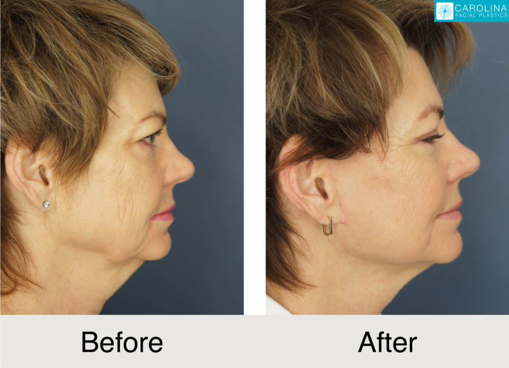 Mini Facelift with Buccal Fat Removal, Facial Fat Grafting, and ...