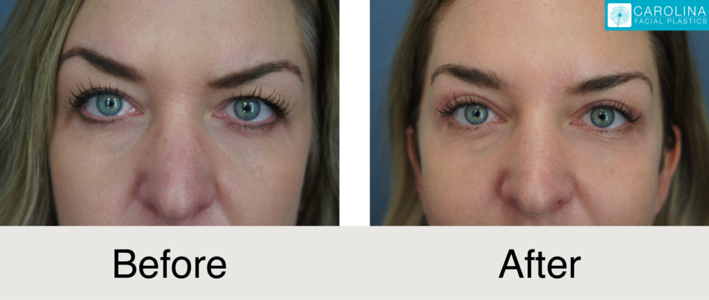 Upper Blepharoplasty to Rejuvenate the Eyes - Carolina Facial Plastics