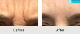 How much Botox do you need for these 10 treatment areas? - Carolina ...