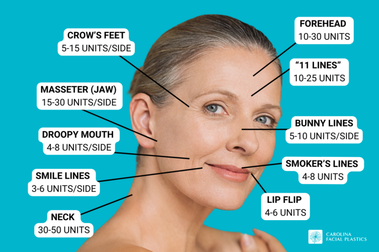 How much Botox do you need for these 10 treatment areas? - Carolina ...