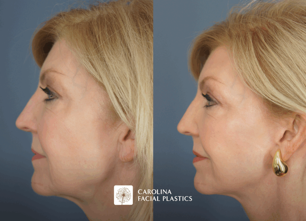 Mini Facelift - Carolina Facial Plastics