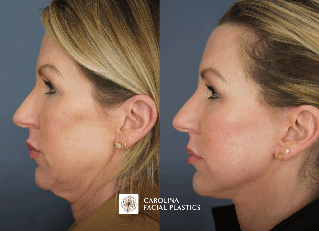 Mini Facelift and Chemical Peel - Carolina Facial Plastics