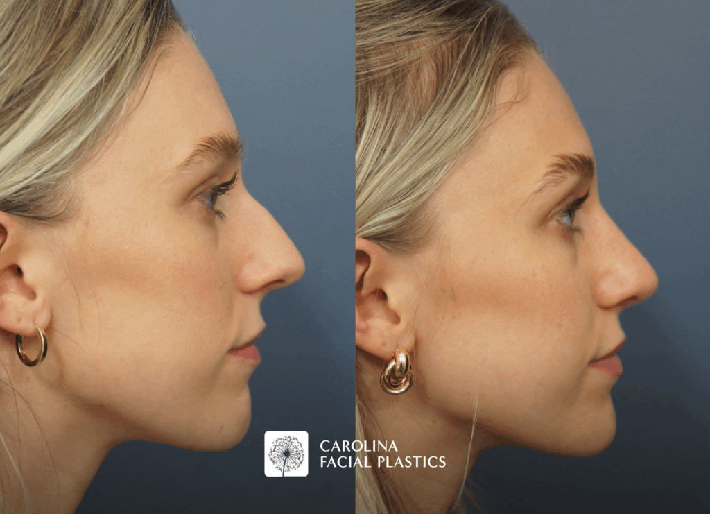 Septorhinoplasty - Carolina Facial Plastics